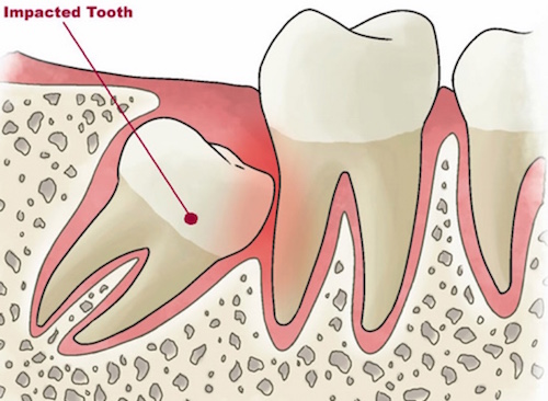 Impacted & Missing Teeth Options - Dr. Parul Mehta & Associates